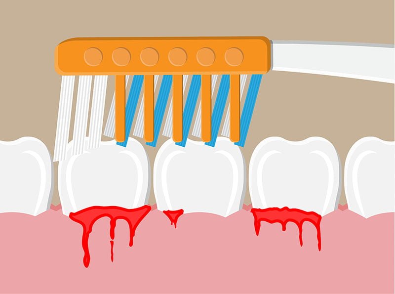Sângerarea gingiilor: cauze și tratament - Omnia Dental - Clinică ...